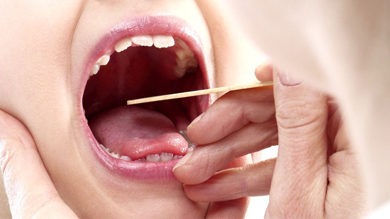 Understanding Strep Throat Symptoms Causes And Prevention